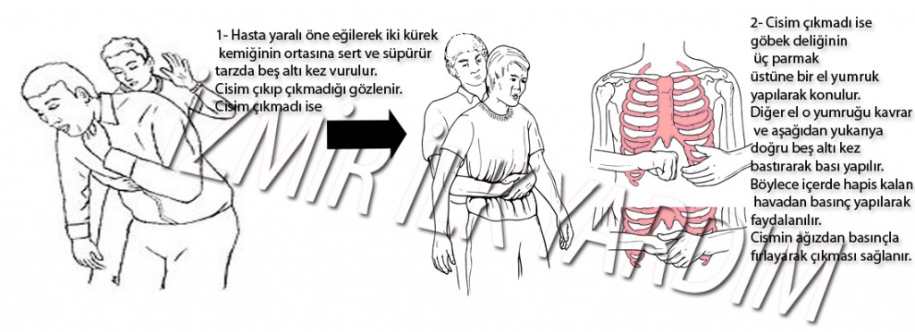 Heimlich Manevrası Nedir ? Nasıl Yapılır ? – İzmir İlk Yardım Eğitimi | İlk Yardım Kursu İzmir ...